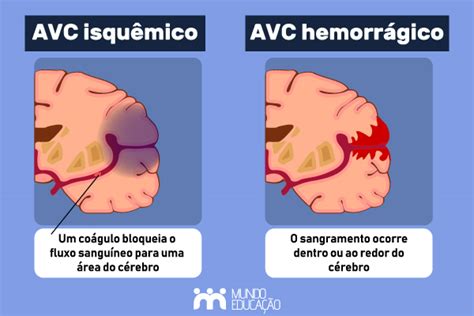 Fisiopatologia Do Acidente Vascular Cerebral Hemorragico