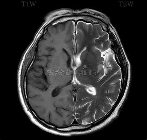 mri brain scan fusion axial t1w and t2w for detect brain diseases sush as stroke disease brain
