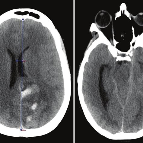 Pdf Decompression Hemicraniectomy For Refractory Intracranial Hypertension In Reversible