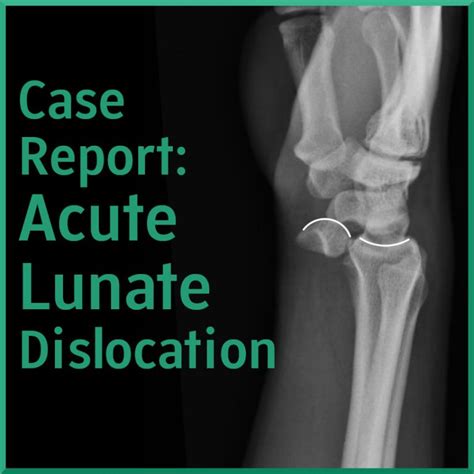Case Report Acute Lunate Dislocation Sports Medicine Review