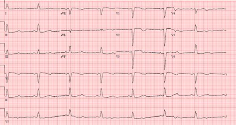 Electrocardiogram Demonstrating Complete Heart Block Download Scientific Diagram