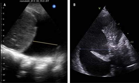 Figure 2 From Utility Of Baliks Formula For The Quantification Of