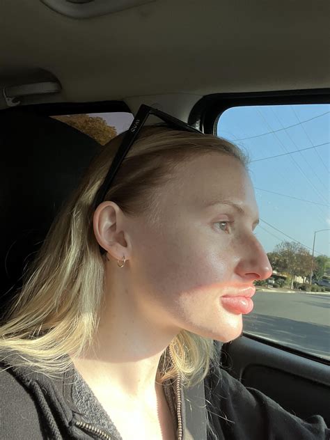One Side Of My Face Looks Droopy And Older Could Fillers In My Upper