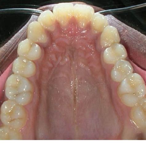 Preoperative Picture Showing Constricted Maxillary Arch Download