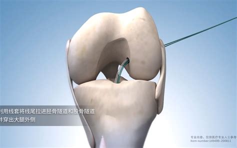 膝关节交叉韧带重建 嘿嘿开玩笑 骨科跟台 哔哩哔哩视频