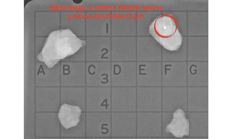 Targeted Axillary Dissection Following Neoadjuvant Chemotherapy The American