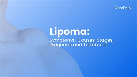 Lipoma Symptoms Causes Stages Diagnosis And Treatment Oncodaily