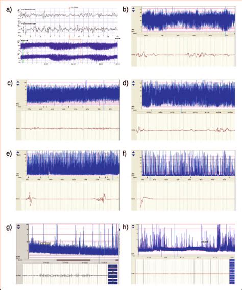 The Classification Of Primary Aeeg Background Patterns As Well As The Download Scientific