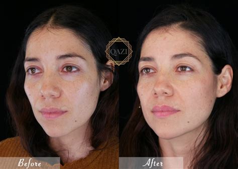 Dermal Fillers The Popular Treatment For A More Youthful Appearance