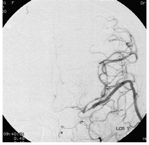 Postoperative Angiogram Of A Left Extracranial Intracranial Radial