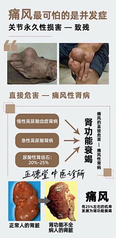 痛风 花瓣网 陪你做生活的设计师 溶晶反应