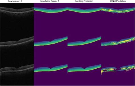 Computational Ophthalmology Big Data Machine Learning Data Science