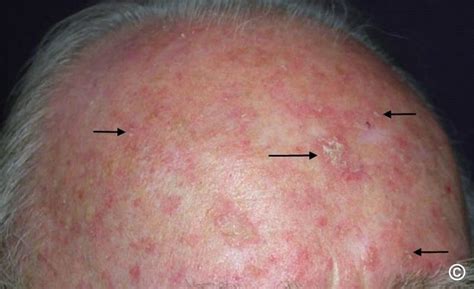 Actinic Solar Keratosis