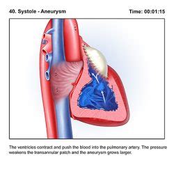 Tetralogy Of Fallot And Transannular Patch Aneurysm Storyboards