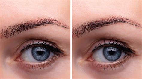 Eyebrow Lift Botox Botox Brow Lift Derma Institute