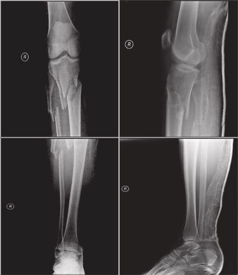 Radiographic Views Demonstrating A Complex Proximal Tibia Fracture Of