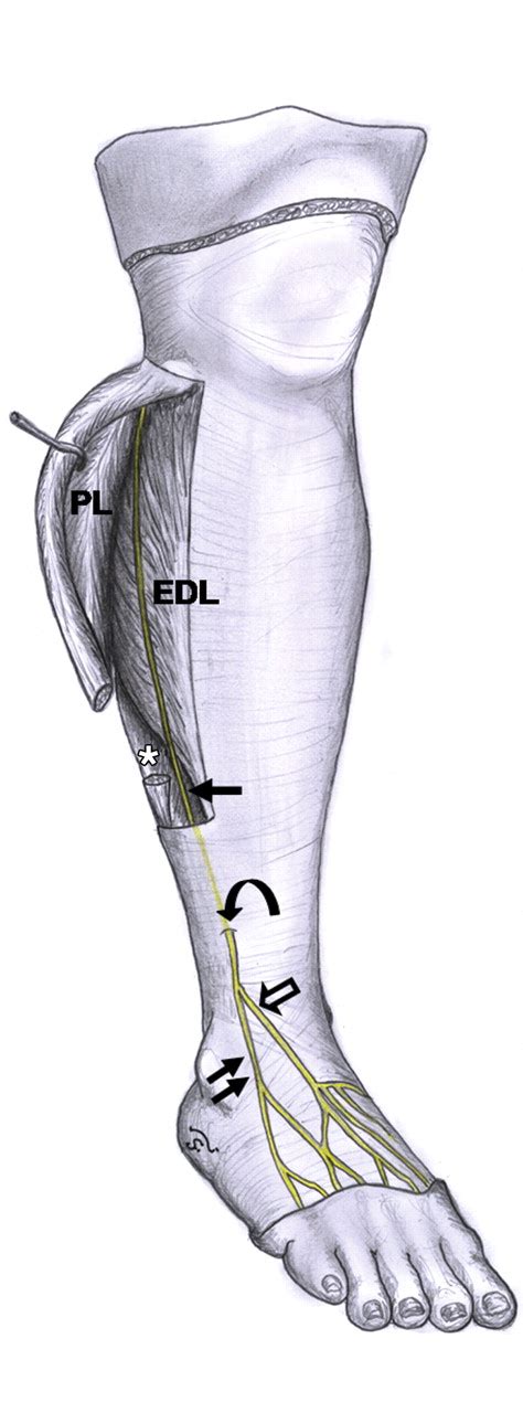 Superficial Peroneal Nerve Ankle Superficial Peroneal Nerve Ankle