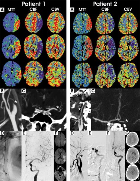 Patient 1 A Ct Perfusion Maps Showing A Large Hypoperfusion Area In Download Scientific