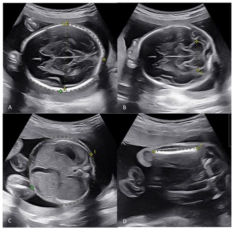Determination Of Efficiency Of Transcerebellar Diameter Abdominal