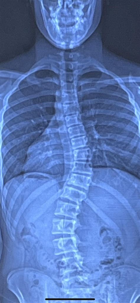 33 Degree Curve Rscoliosis