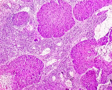 Premium Photo Photomicrograph Showing Tongue Squamous Cell Carcinoma