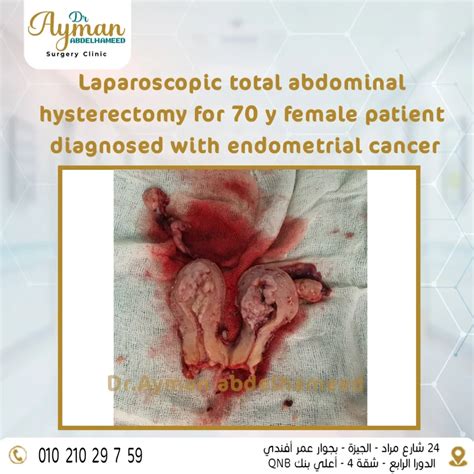 Laparoscopic Total Abdominal Hysterectomy Drayman Abd Elha