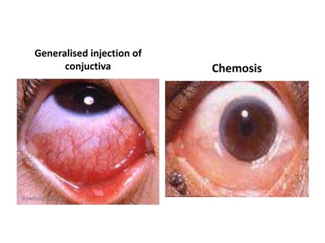 Diseases Of Conjunctivapptx