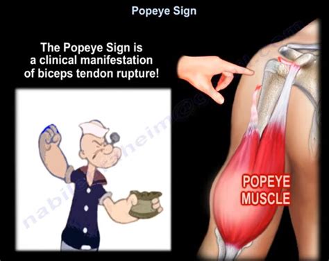 Proximal Biceps Tendon Rupture —