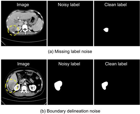 论文审查 Deep Self Cleansing For Medical Image Segmentation With Noisy Labels