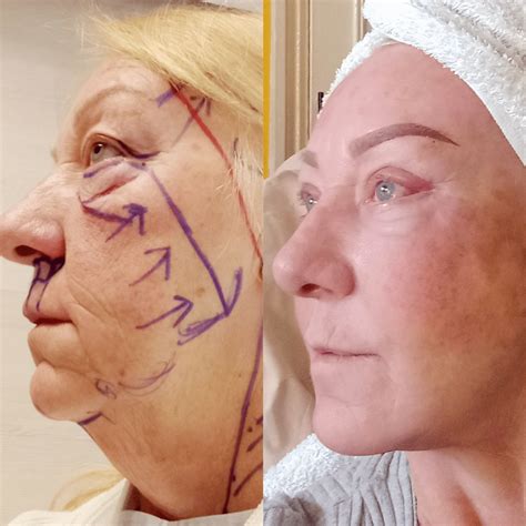Før Og Etter Bilder Av Ansiktsløft Nordesthetics Clinic