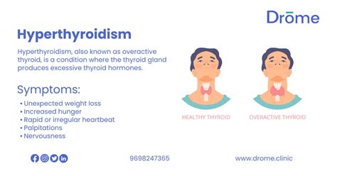 Hyperthyroidism Causes Symptoms And Treatment Drome Clinic