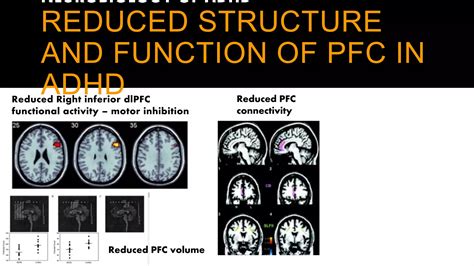 Neurobiology Of Attention Deficit Hyperactivity Disorder Ppt