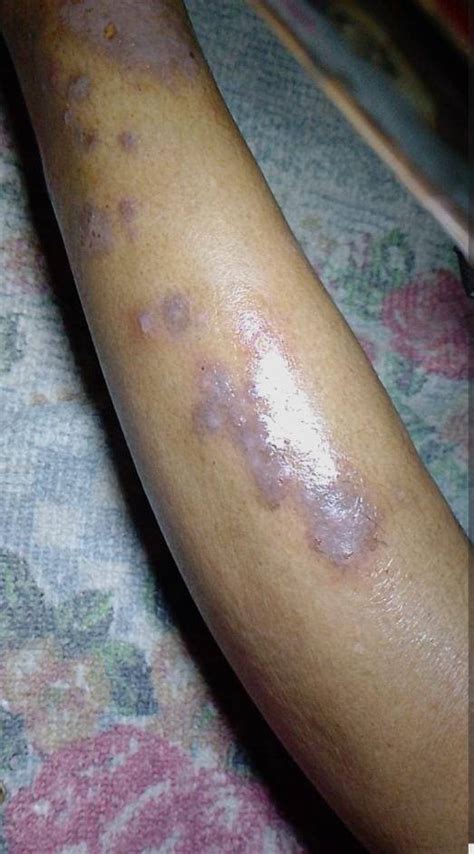 Masalah Kulit Di Kaki Hellosehat