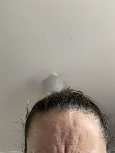 Scleroderma Morphea R Scleroderma