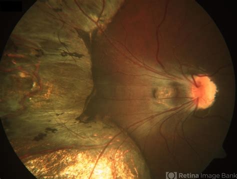 Progressive Bifocal Chorioretinal Atrophy Retina Image Bank