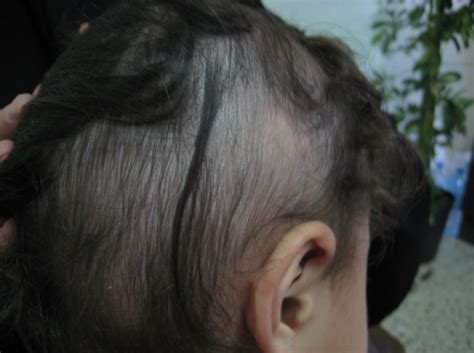 Scalp Biopsy And Diagnosis Of Common Hair Loss Problems Intechopen