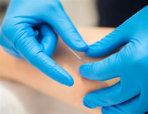 The Ultimate Guide To Dry Needling For Sciatica