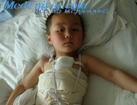 Лапароскопические операции у детей. Операция при паховой грыже ...