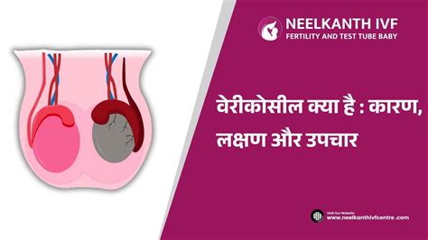 वेरीकोसील कारण लक्षण और उपचार Varicocele In Hindi