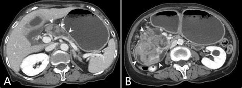 Contrast Enhanced Axial Computed Tomography Scans A Mild Enhancing Download Scientific