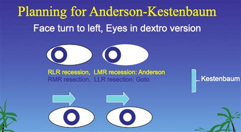 Schematic Drawing Showing The Shifting Of Eccentric Gaze Null In
