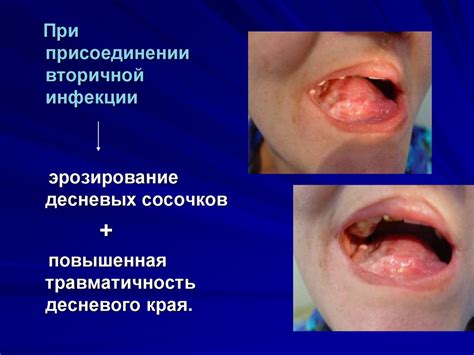 Изменения полости рта при заболеваниях внутренних органов презентация онлайн