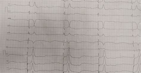 Cardiology Window Hyperkalemia Induced High Grade Av Block