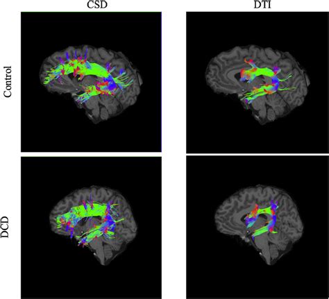 A Visual Representation Of Slf Tracts Using Csd And Dti Modelling In A Download Scientific