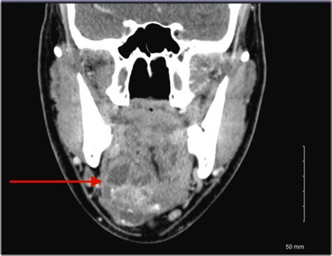 Papillary Carcinoma Arising In A Presumed Thyroglossal Duct Cyst With