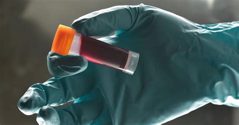 Triglyceride Level Test Procedure Preparation And Risks