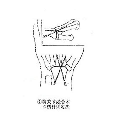 腕关节病灶清除术图解 手术图解 医学图库