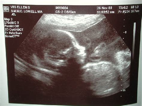 25 неделя беременности фото живота УЗИ и вес плода боли и выделения на 25 неделе