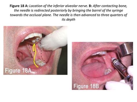 Mandibular Nerve Block Pptx