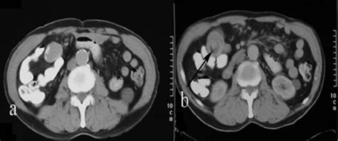 Small Intestinal Gist In A 60 Year Old Woman With Acute Abdominal Pain Small Intestinal Gist In A 60 Year Old Woman With Acute Abdominal Pain